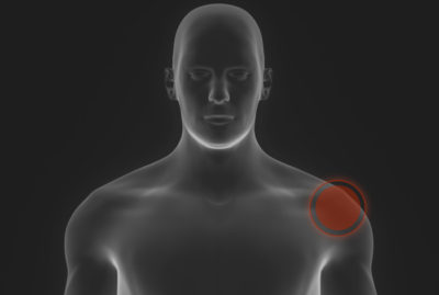 Thoracic Outlet Syndrome - T.E.A.M. CLINIC®